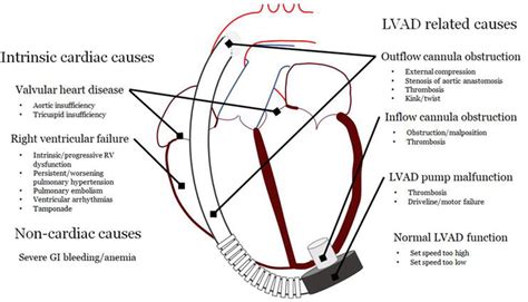 Lvad For Heart Failure