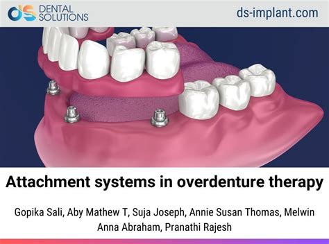 Pdf Attachment Systems In Overdenture Therapy A Review 2023