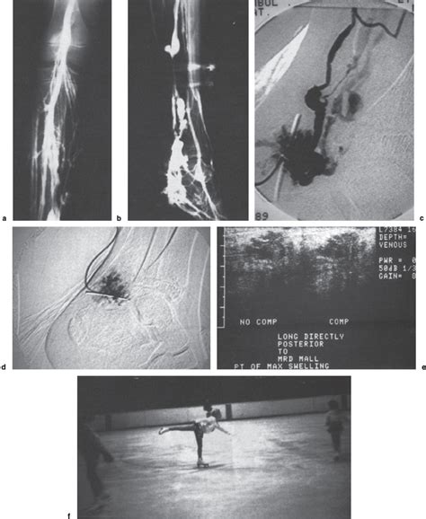 Diagnosis And Management Of Venous Malformations Radiology Key