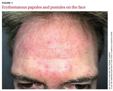 Papules Or Pustules