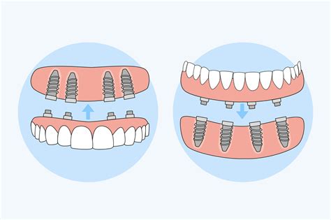 All On X Dental Implant Procedure A Step By Step Guide