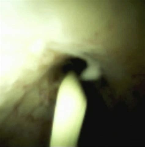 Common Hepatic Duct Stricture With Increased Vascularity With Guidewire