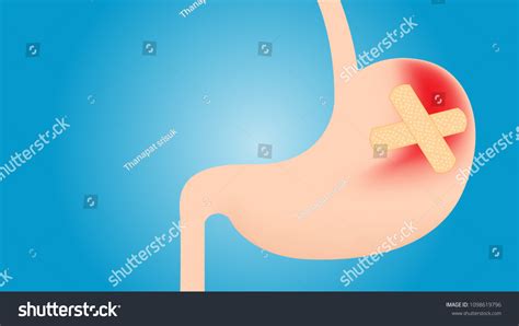 Ulcer On Plaster Stock Vector Royalty Free 1098619796 Shutterstock