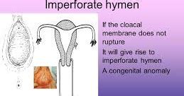 Imperforate Hymen အပ်ိဳေျမွးပိတ္ေနျခင္း