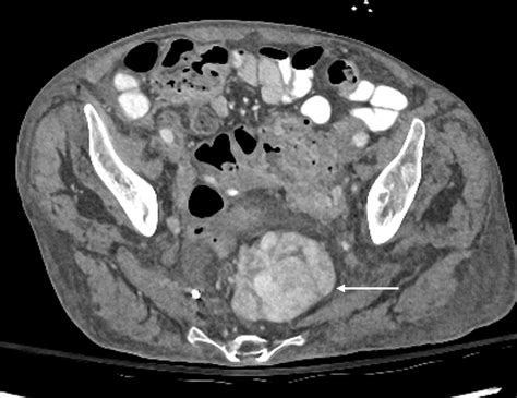 Solitary Fibrous Tumour Of The Pelvis Eurorad