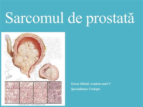 Prostatic Sarcomappt
