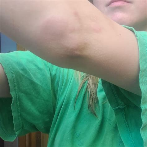 What Are These Raised Circles On My Elbows Rmedicaladvice