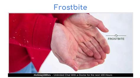 Frostbite Pdf