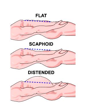 Scaphoid Abdomen Shape May Be Hard To Distinguish An