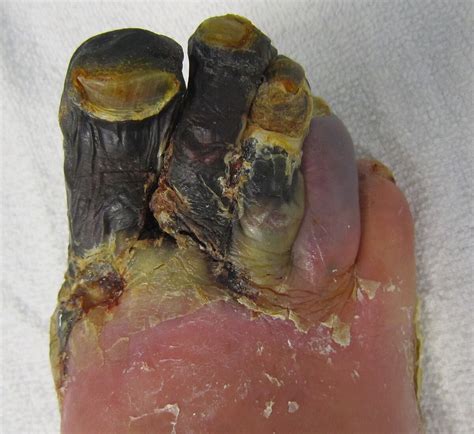 Gangrene Wikipedia