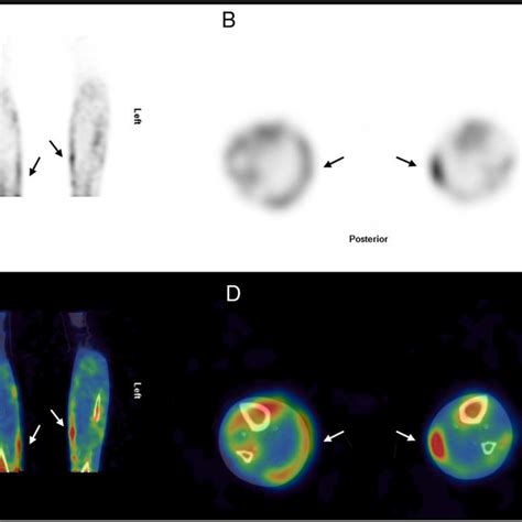Bone Spect Coronal A And Axial B Sections Bone Spectct Coronal