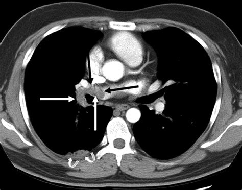 Radiologic Findings Of Peripheral Primitive Neuroectodermal Tumor Arising In The Retroperitoneum