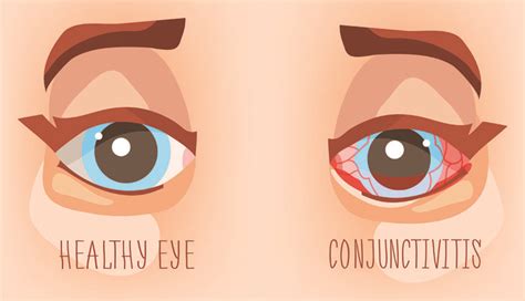 What You Need To Know About Conjunctivitis Low Vision Aids