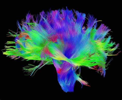 Mri Of The Brain Using Diffusion Tensor Imaging Dti Analysis Pics