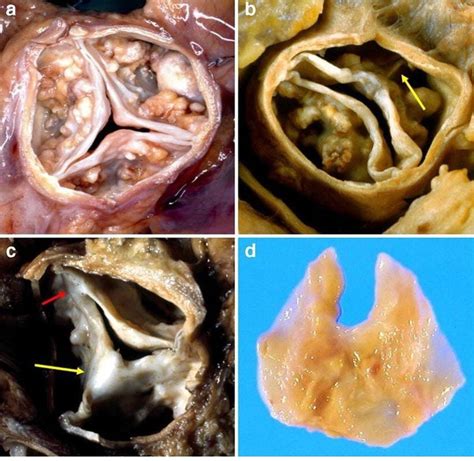 Aortic Valve Pathology Medizzy