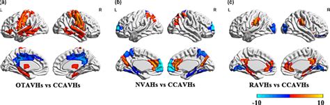 Global Functional Connectivity Density Gfcd Alterations Among Three