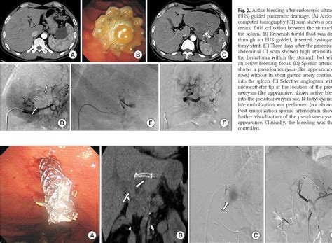 Endoscopic Hemostasis Failure At Jonathan Worgan Blog
