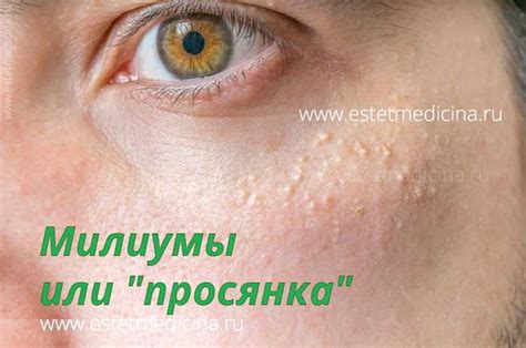 Лечение липоматоза