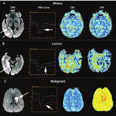 Mri Findings In Acute And Subacute Strokes A During Acute Stroke
