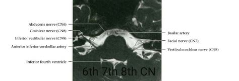 Mri Of Cranial Nerves