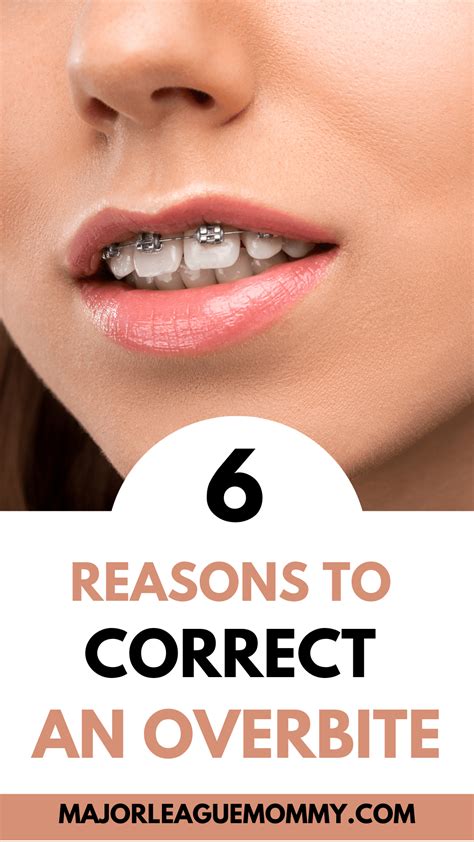 6 Reasons To Correct An Overbite Major League Mommy
