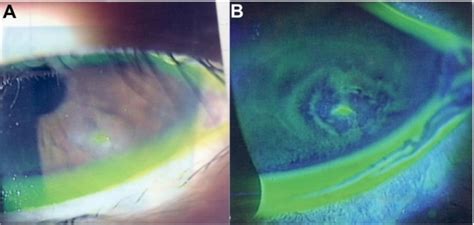 Persistent Corneal Epithelial Defect Responding To Rebamipide