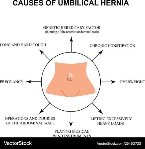 Umbilical Hernia