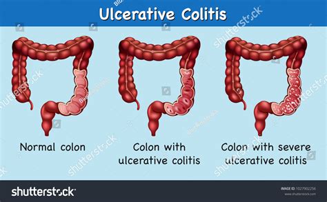 Ulcerative Colitis