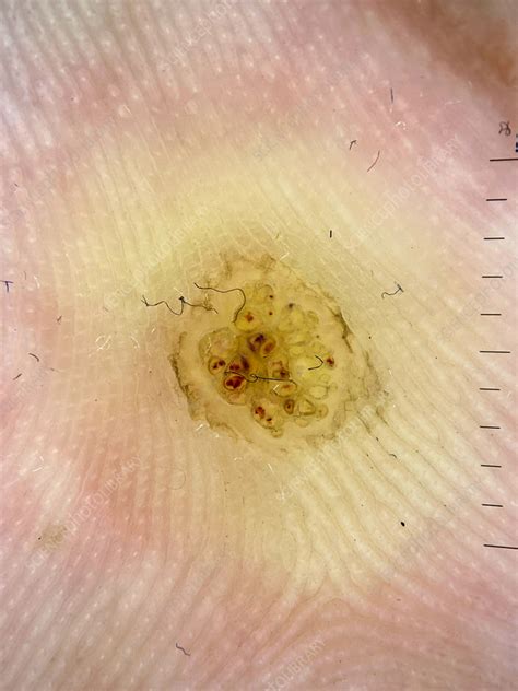 What Does A Wart Look Like Under A Microscope