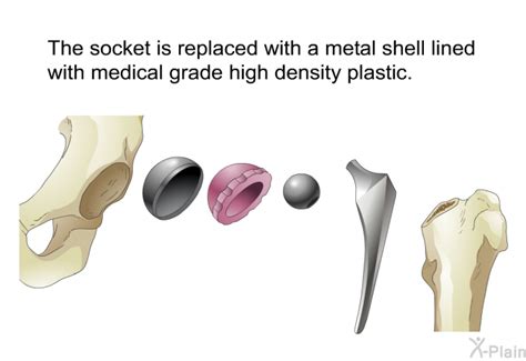 Hip Replacement Surgery Preventing Post Op Complications