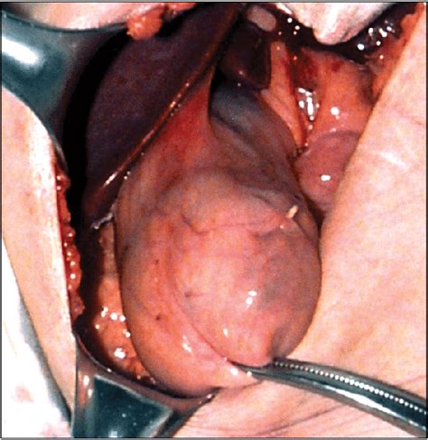 Operative Finding Of A Dilated Gallbladder With A Normal Outer Surface Download Scientific