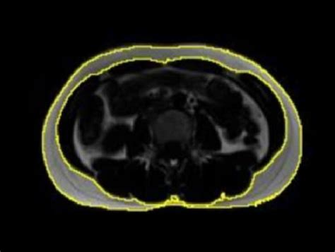 The Abdominal Subcutaneous Adipose Area Sat A And The Visceral Download Scientific Diagram