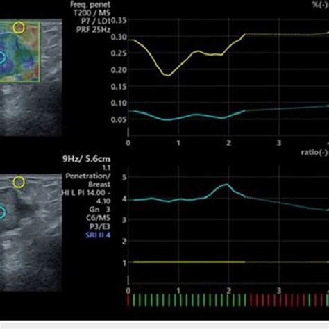 Elastography Of Invasive Ductal Carcinoma Same Patient Images Shown In