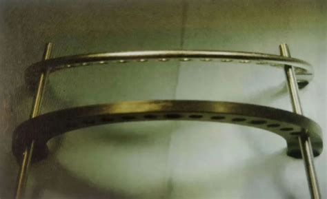 一文了解 胫骨近端骨折：环形外固定架固定架克氏针膝关节胫骨骨折 健康界