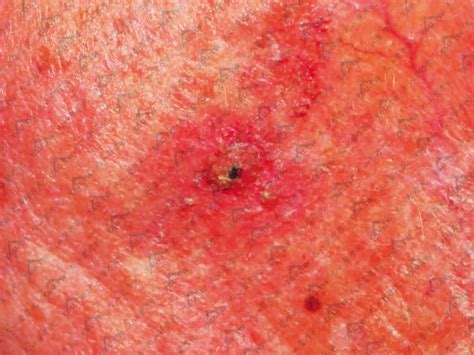 光线性角化病（老年日光性角化病）症状、诊断治疗参考 皮肤病学 天山医学院