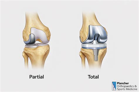 Partial Vs Total Knee Replacement In Nyc Which Arthroplasty Is Right