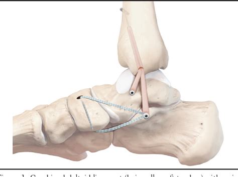 Torn Deltoid Ligament