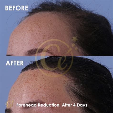 Forehead Reduction In Turkey Results Dr Cengizhan Ekizceli