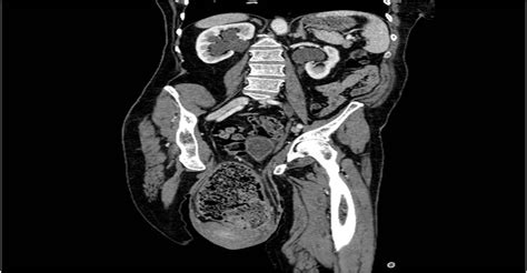 Complete Procidentia Temporizing Treatment With An Obstetri Obstetrics And Gynecology