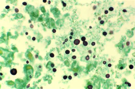 Cryptococcus Histology