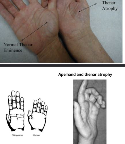 Ape Hand Median Nerve