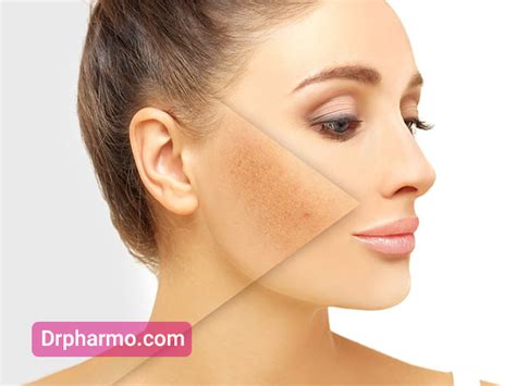 هایپرپیگمنتیشن چیست جدیدترین روش های درمان هایپرپیگمنتیشن