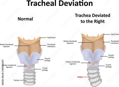 Tracheal Deviation Stock Illustration Adobe Stock