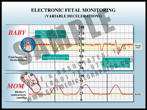 Efm Variable Decelerations Sanda Medical Graphics