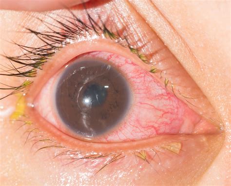 24 Hour Ophthalmic Emergencies Part 1 Acute Red Eye Rcemlearning