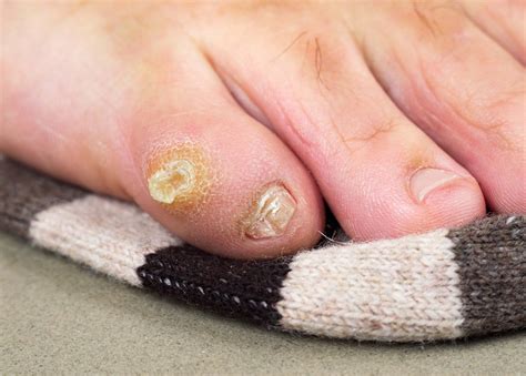 How To Get Rid Of Soft Corn Between Toes