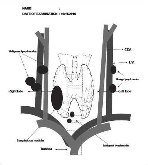 Schematic Representation Of Lymphatic Mapping Of The Neck In A Patient
