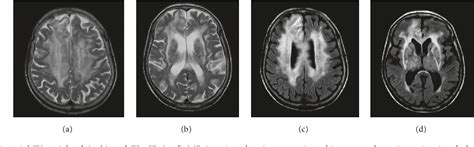 Figure 1 From Disseminated Necrotizing Leukoencephalopathy Complicating Septic Shock In An