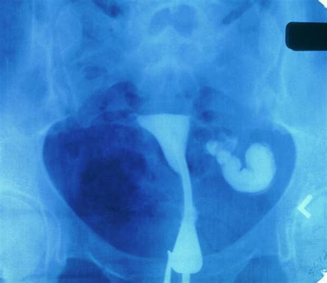 Hysterosalpingogram Posters Fine Art America