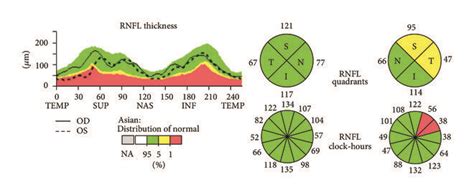 A Localized Wedge Shaped Rnfl Defect Yellow Arrowheads Was Observed